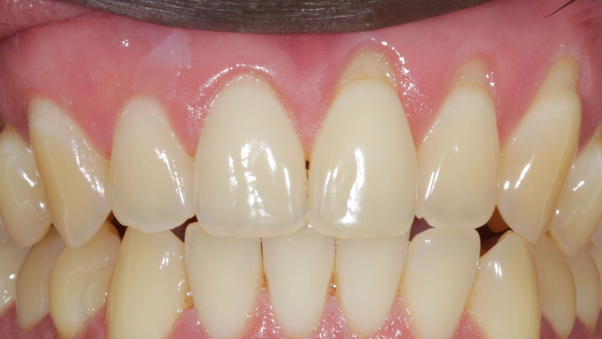 Receding gums: causes and treatment - Perio by Dantis